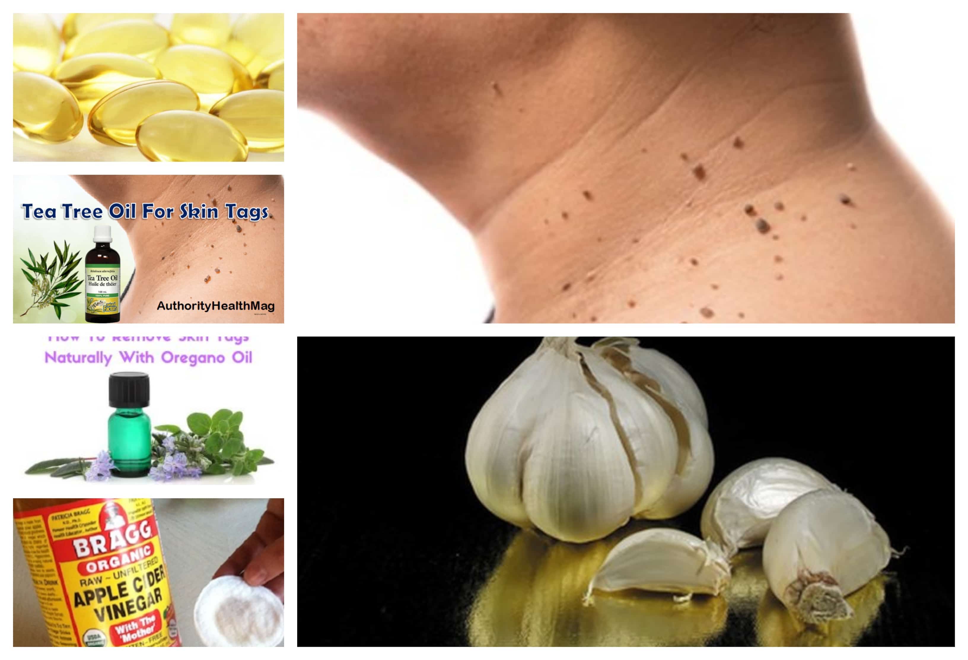Natural And Safe Ways To Get Rid Of Unwanted Skin Warts - ALL FOR ...