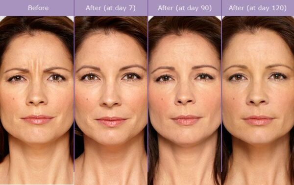 How Does Botulinum Toxin (Botox) Work? - ALL FOR FASHION DESIGN