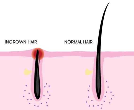How to Get Rid of Ingrown Hairs - Tips and Tricks - ALL FOR FASHION DESIGN